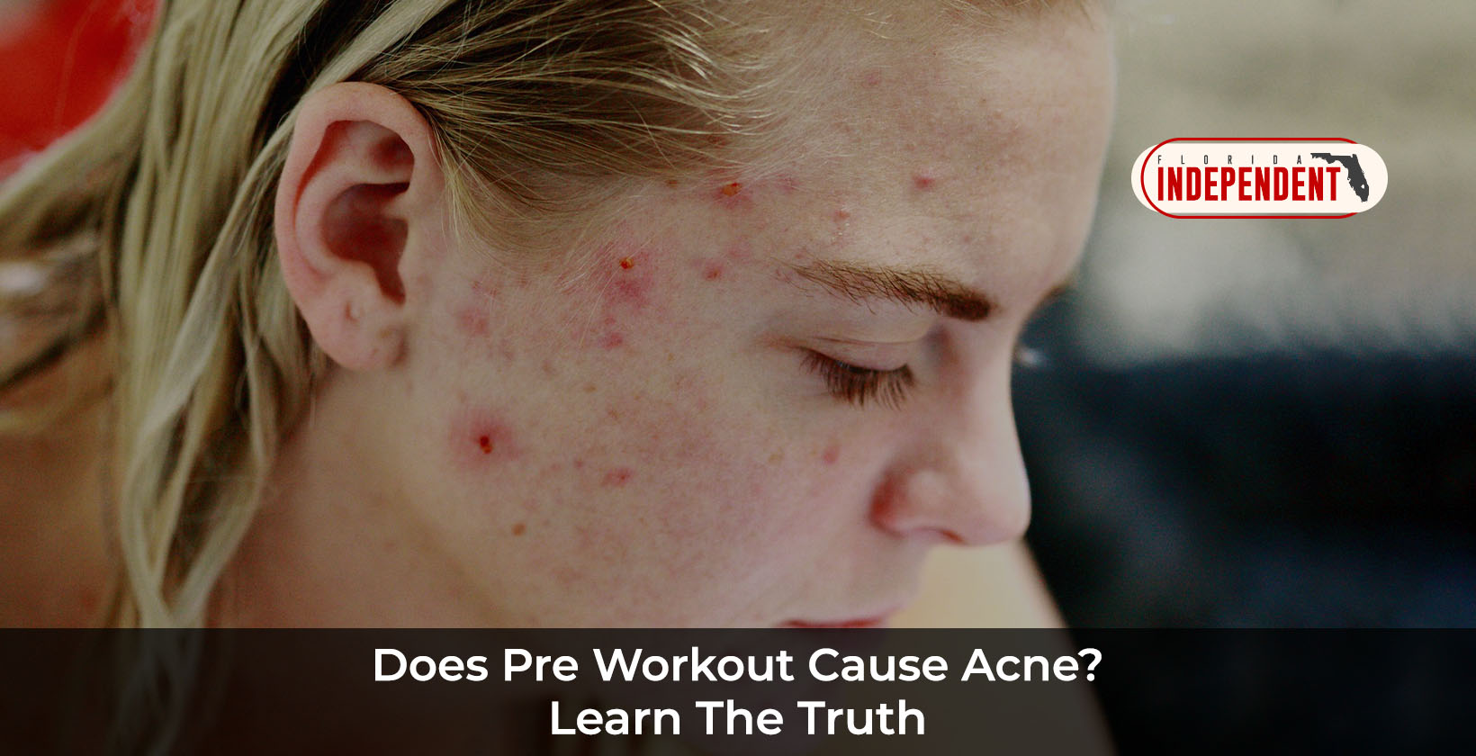 Does Pre Workout Cause Acne? - Florida Independent